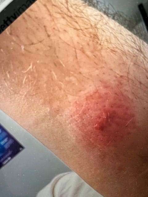 Ticks in Washington State: What You Need to Know and How to Protect ...